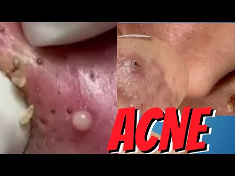 The Complete Acne Treatment Guide: How to Get Clear Skin - Part 1