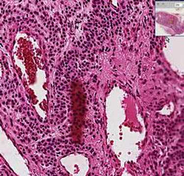 Glomus Tumor - Pathology - Orthobullets