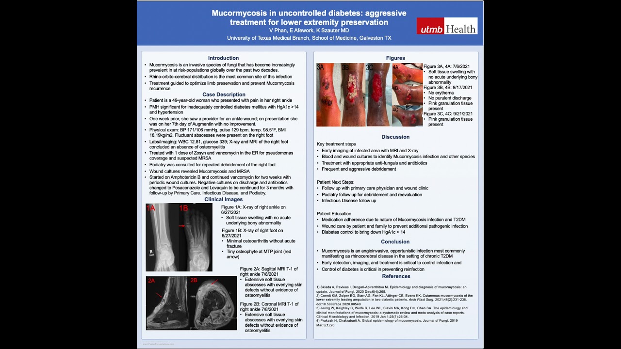 Mucormycosis ACP Abstract Presentation 2021