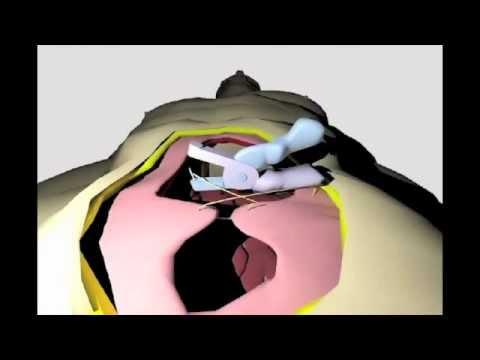 FastStitch - Open Minds Submission