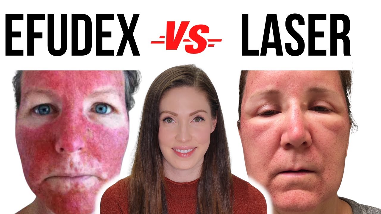 Why Everyone Is Raving About Micro Laser Peel—And You Should Be Too | The Skin Science Collective