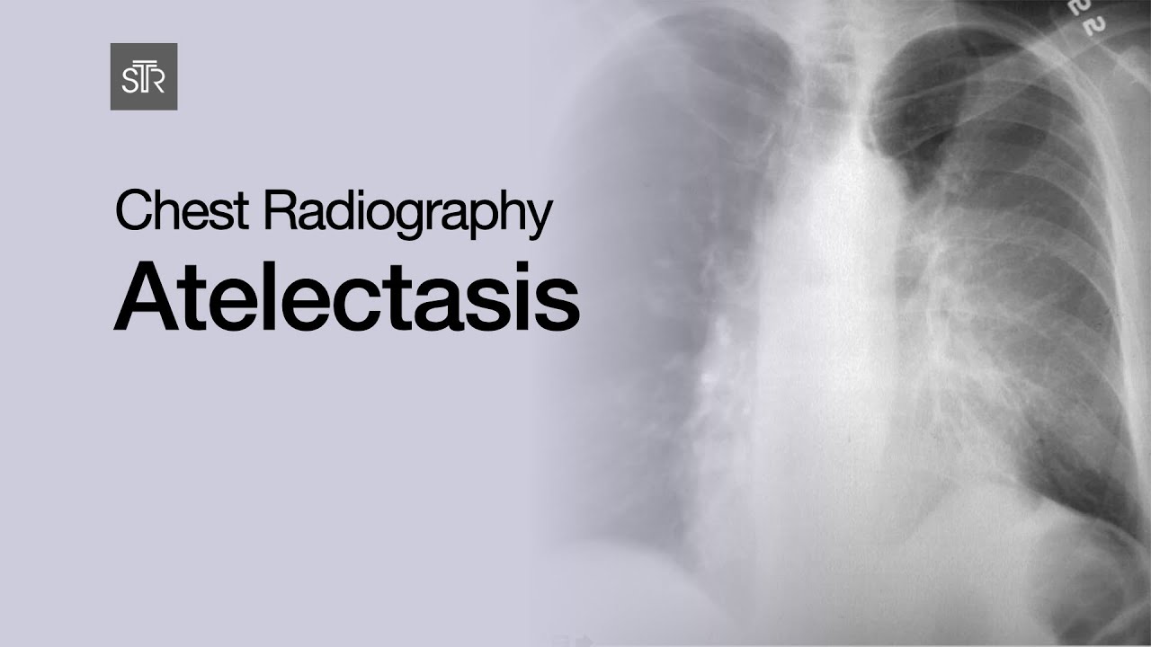 Chest Radiography: Atelectasis