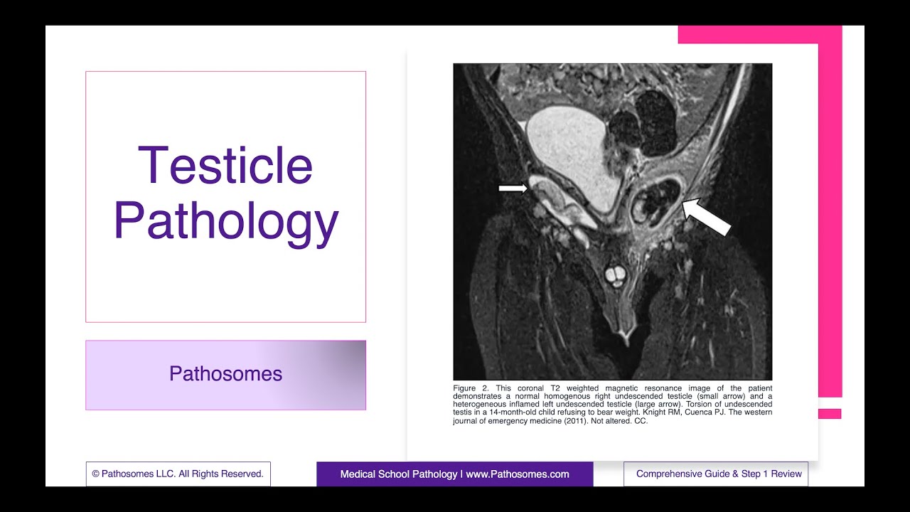 Testicle Pathology | Comprehensive Guide & Step 1 Review | Pathology Step 1 USMLE