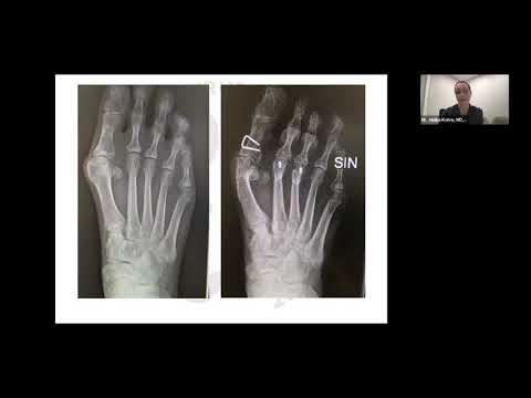 Inion Webinar: Dr. Helka Koivu - Hammertoe Correction Surgeries with the Inion FreedomPin™