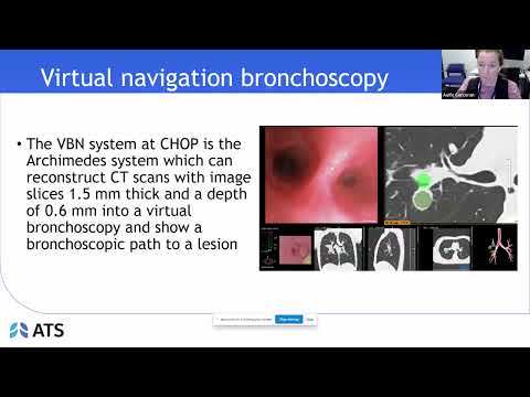 Diagnostic Yield of Endobronchial Ultrasound and Virtual CT Navigational Bronchoscopy