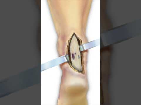 Achilles Tendon Repair Open - PreOp® Patient Eduction #medicine #patienteducation #medical