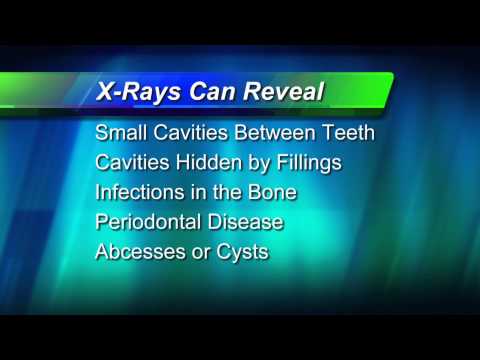Why X-Ray?