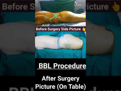 Brazilian Butt Lift Procedure | Before and After of BBL
