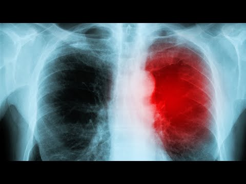 Clozapine-Induced Myocarditis