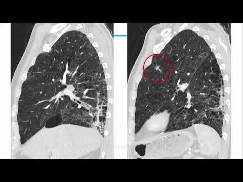 Intelligent Healthcare in CT imaging - Matthias Prokop