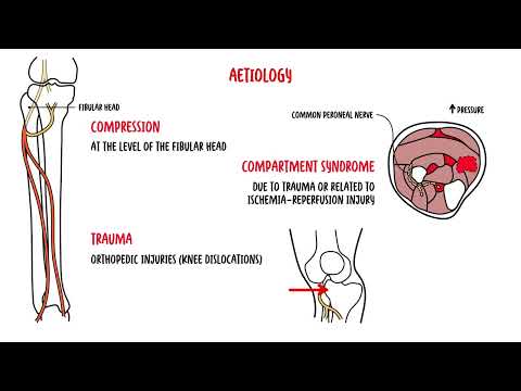 What is Foot Drop? Causes, Symptoms & Treatment Explained • Video ...