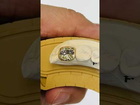 14Kt #Gold Crown #dental #teeth #smile #lsk121shorts #shortvideo #shorts