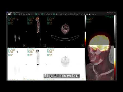 Whole-body PET-CT data from United Imaging's scanner uExplorer in Hermia software.
