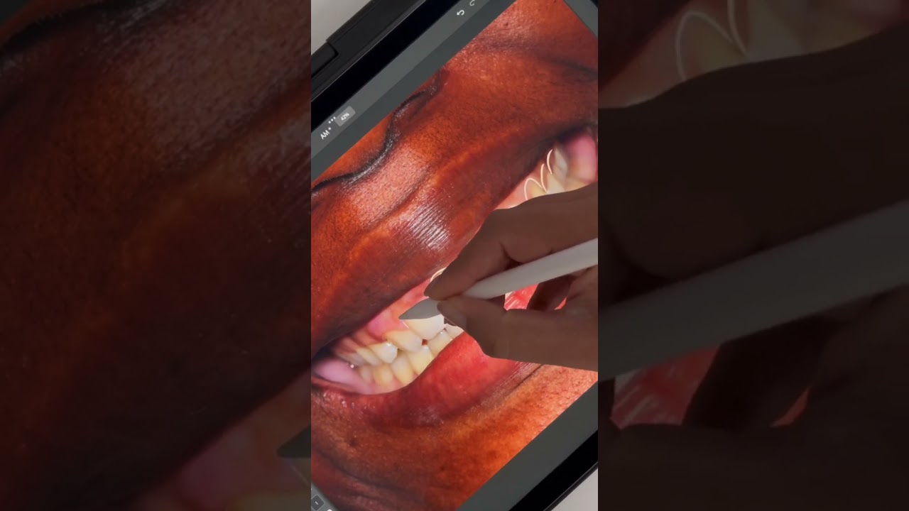 Gum Sculpting Treatment #GumSculpting #GumAesthetics #London #DentalTreatment #Shorts