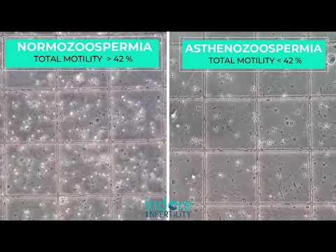 Asthenozoospermia | Sperms with Low Motility | Side by side comparison Normal Vs Asthenozoospermia