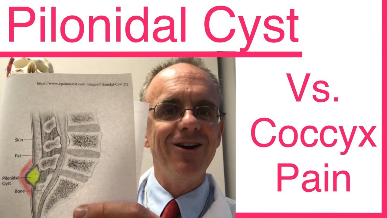 Do you have a PILONIDAL CYST, or is it Coccyx Pain, Tailbone Pain
