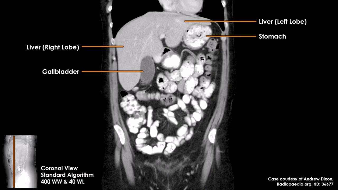 Liver & Gallbladder Anatomy on CT Scans