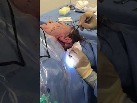 Facelift Surgery - Creating an Inconspicuous Scar