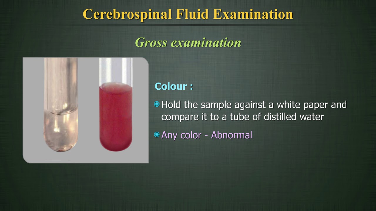 Cerebrospinal Fluid Examination (CSF)