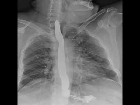 Dynamic Digital Radiology Retrospective View of Esophagus: Esophagogastroduodenoscopy (SEGD) part 2