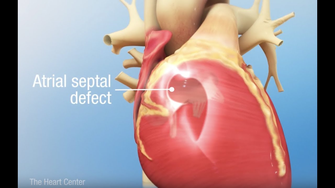 Understanding Atrioventricular (AV) Septal Defect