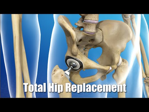 Total Hip Replacement