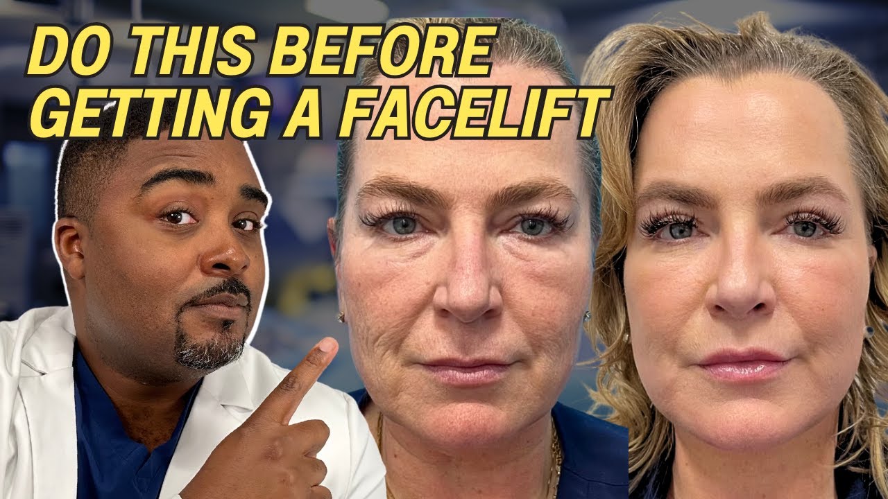 Everything You Need to Know BEFORE Getting A Facelift