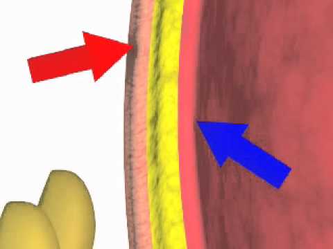 Paracentesis NEJM