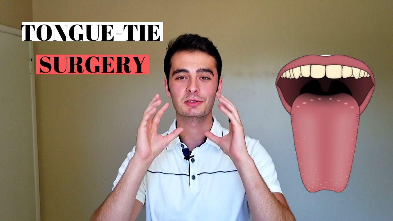 Tongue Tie Release (Lingual Frenectomy): Was It Worth It?