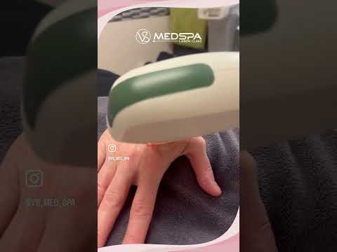 Hands Rejuvenation with IPL Photofacial