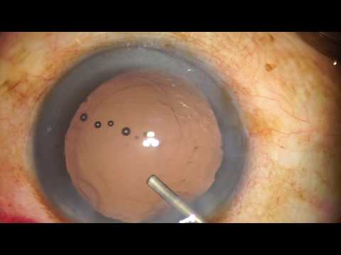 What Grade is this Cataract ? - Dr Ramakrishna Tadanki