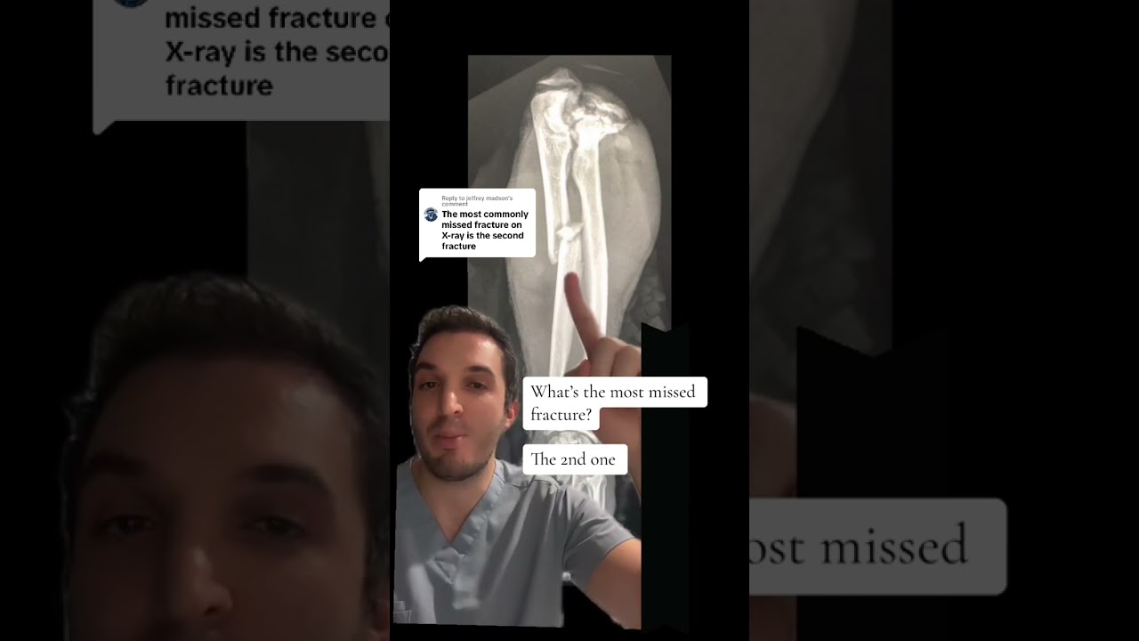 What’s the most missed fracture on an xray?