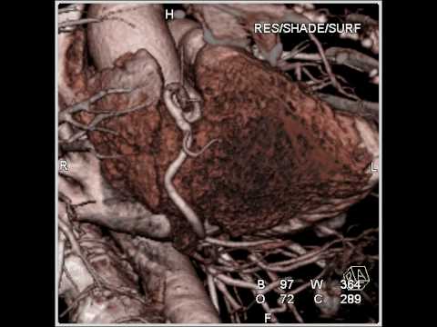 Cardiac: Coronary CTA (1 of 1)