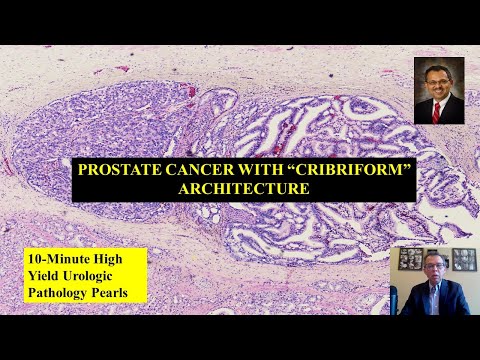 Prostate Cancer with "Cribriform Architecture"