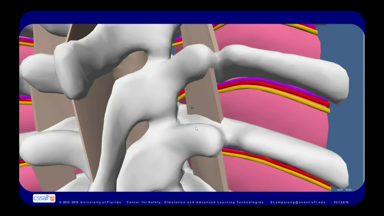 Anatomic Boundaries of the Thoracic Paravertebral Space