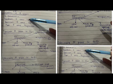 R wave# progression#abnormalities#dominant R wave # poor R wave progression