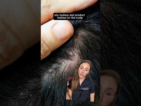 Get Rid Of Scalp Build Up!