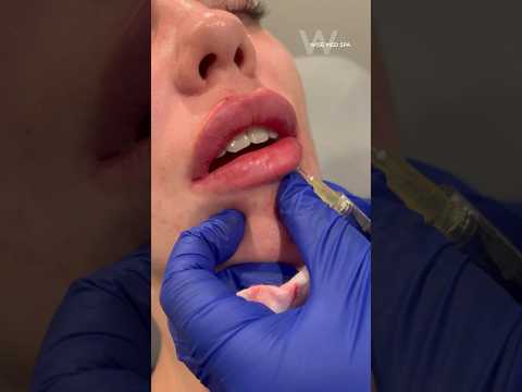 Before & After: Restylane Kysse Lip Fillers
