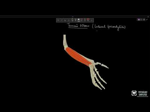 Lateral Epicondylitis - A brief overview of Tennis Elbow