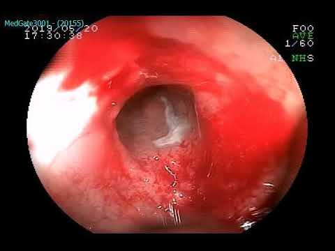20052019 Colonoscopy for Terminal ileitis with ulcers