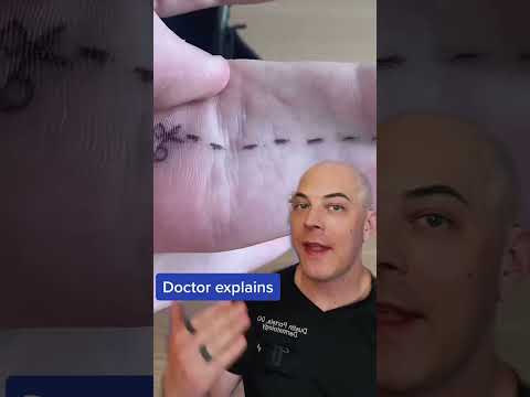 Doctor explains syndactyly! #dermreacts #doctorreacts #syndactyly