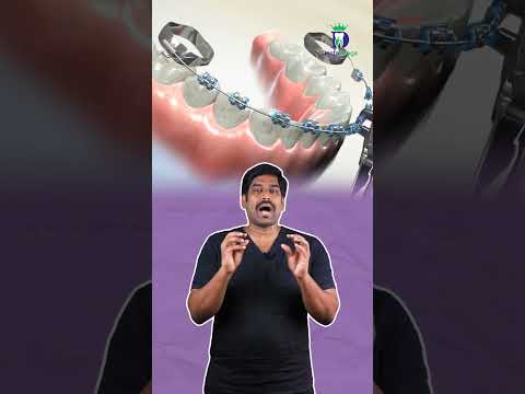 கிளிப் கழட்டிய பிறகு மஞ்சளாக தெரிகிறதா? What happens after debonding braces? | Denta Kings #shorts