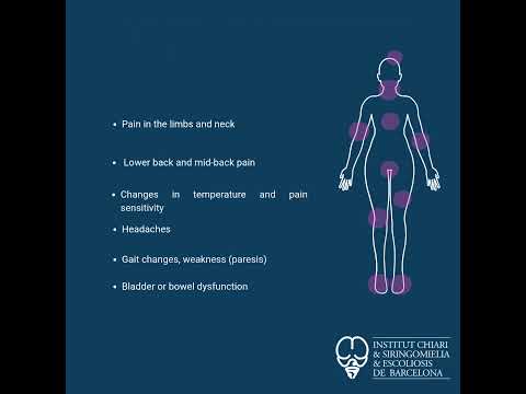 What is idiopathic syringomyelia? | Institut Chiari de Barcelona