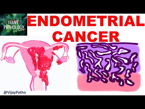 ENDOMETRIAL CARCINOMA: Risk factors, Etiopathogenesis, Morphology & Clinical features