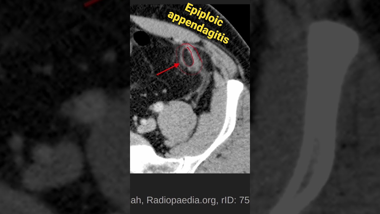 Epiploic appendagitis