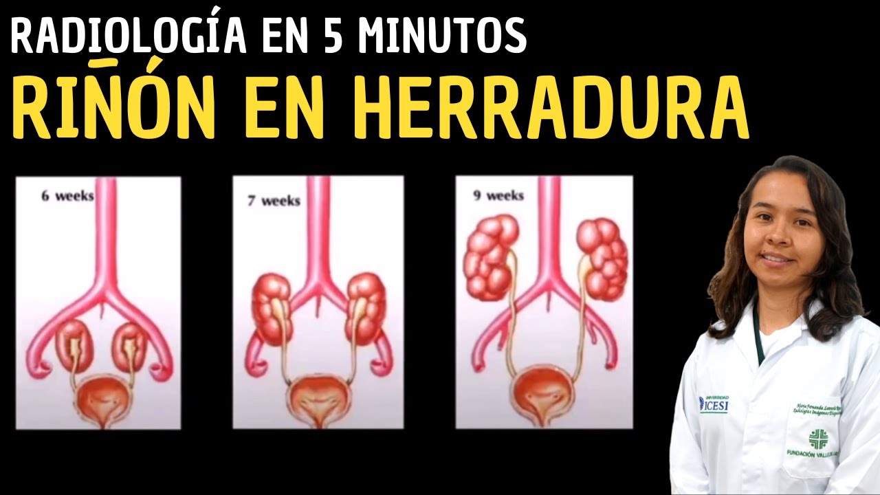 Horseshoe kidney: Radiology in 5 minutes.