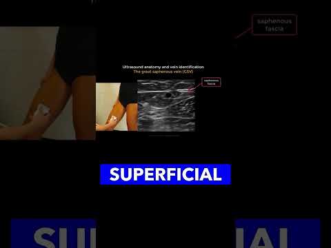Identifying the Great Saphenous Vein #vascularultrasound #healthcareexcellence #MedicalEducation