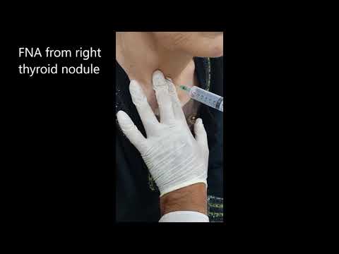 metastatic cholangiocarcinoma to supraclavicular LN
