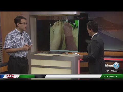 Ask a Specialist: Complex Regional Pain Syndrome