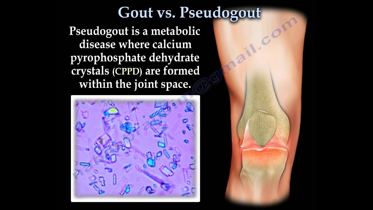 Gout and Pseudogout, Joint Pain- Everything You Need To Know- Dr. Nabil Ebraheim